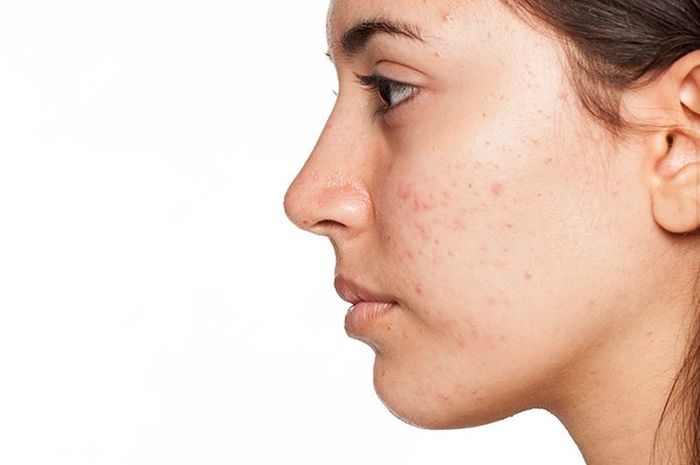 Waspada! 5 Kebiasaan Buruk Remaja Ini Bikin Kulit Rusak Sebelum ...