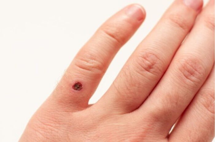 3 Cara Mengobati Kutil dan Mencegahnya Agar Tidak Terjadi Lagi - Grid ...