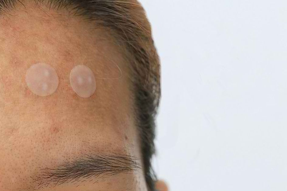 Acne Patch Dianggap Lebih Cepat dan Ampuh Menghilangkan Jerawat