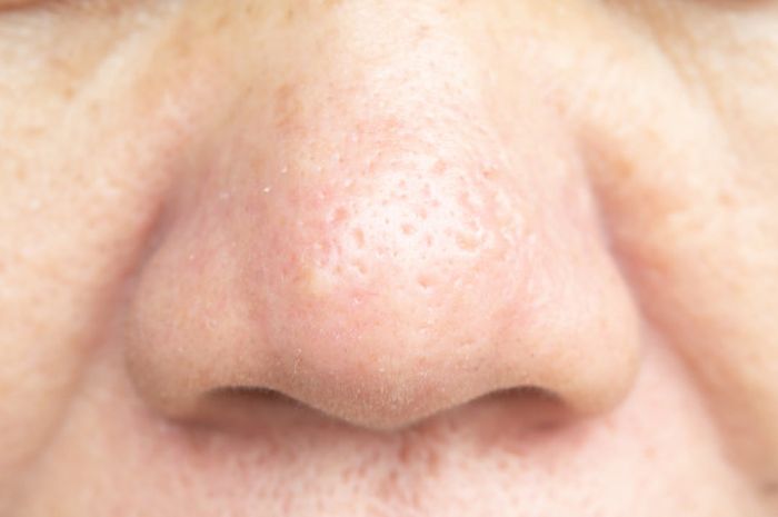 10 Langkah Menghilangkan Komedo, Kulit Wajah Dijamin Bersih dan Sehat ...