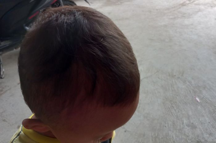 Cara Mengatasi Rambut Rontok Pada Anak Kurus Kurang Gizi, Cukup Pakai ...