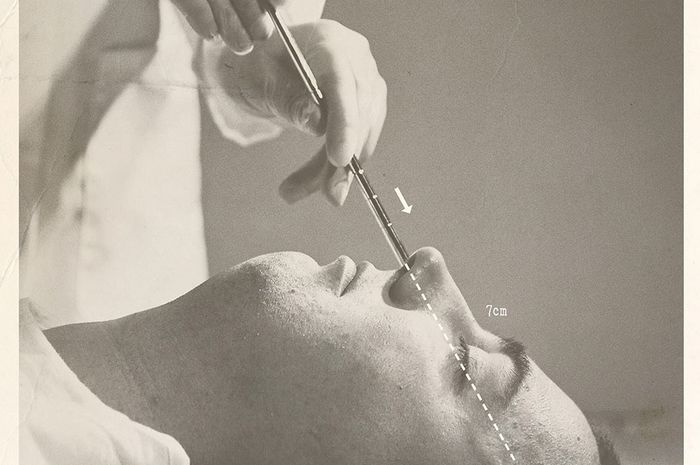 Sejarah Mengerikan Lobotomi: Ketika Ribuan Kepala Manusia Dilubangi ...