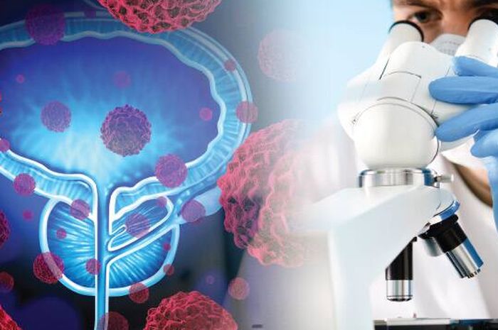 Tanda-tanda Terkena Kanker Prostat pada Laki-laki, Cegah Sebelum Telat ...