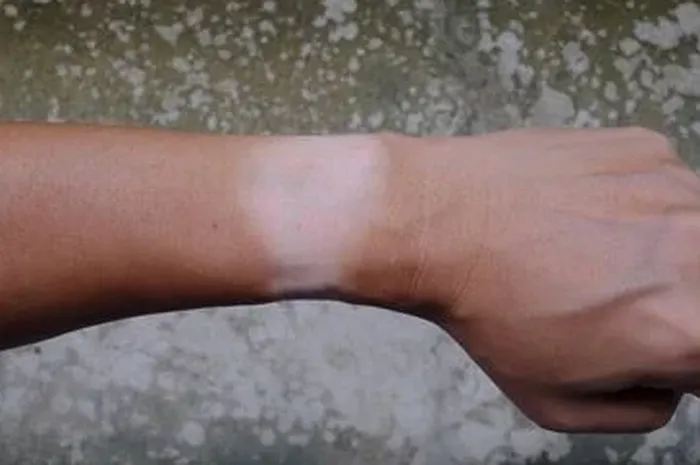 Super Mudah! Ini 5 Perawatan Rumahan Buat Atasi Kulit yang Belang ...