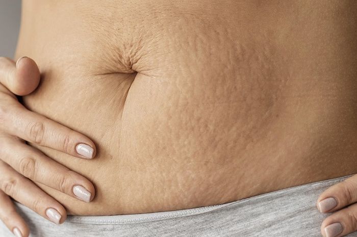 Perbedaan Stretch Mark Putih dan Merah, Mana yang Lebih Susah ...