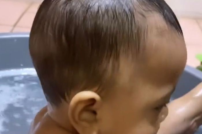 Jangan Panik! Inilah Penyebab Munculnya Bintik Merah di Kepala Bayi ...