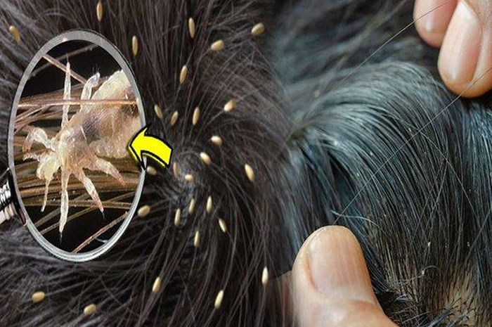 Ih Bikin Malu Kalau Dilihat Teman! Rambut yang Penuh Kutu Bakal Lenyap hingga Ke Akar dengan 2 ...