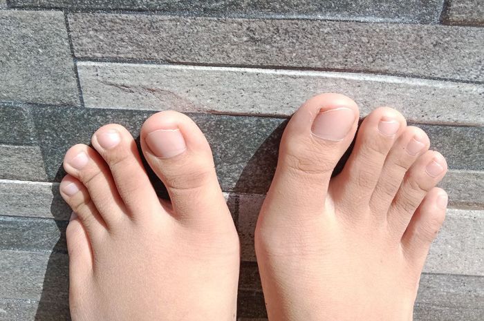 Sering Muncul di Kaki, Ketahui Penyebab Kutu Air dan Cara Mengobatinya ...