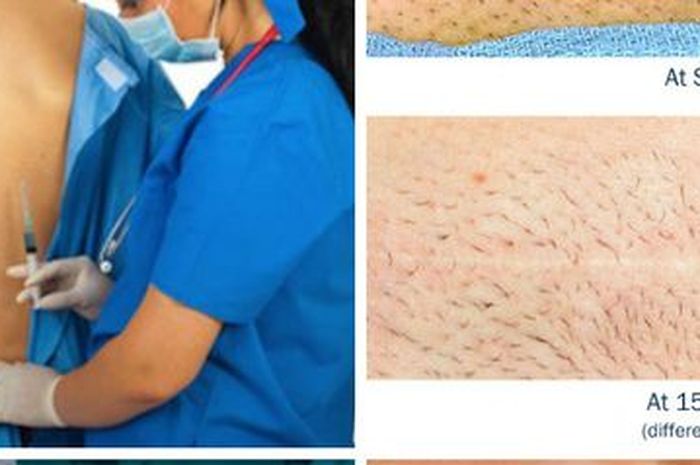 2 Cara Menghindari Rasa Nyeri Usai Persalinan Sesar Menurut Dokter ...