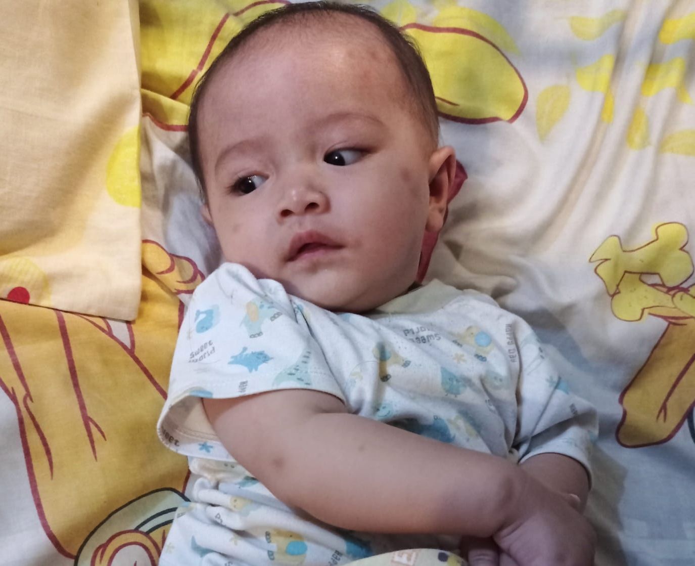 "A Complete Guide to Measles in Babies: Symptoms, Preventions, and ...