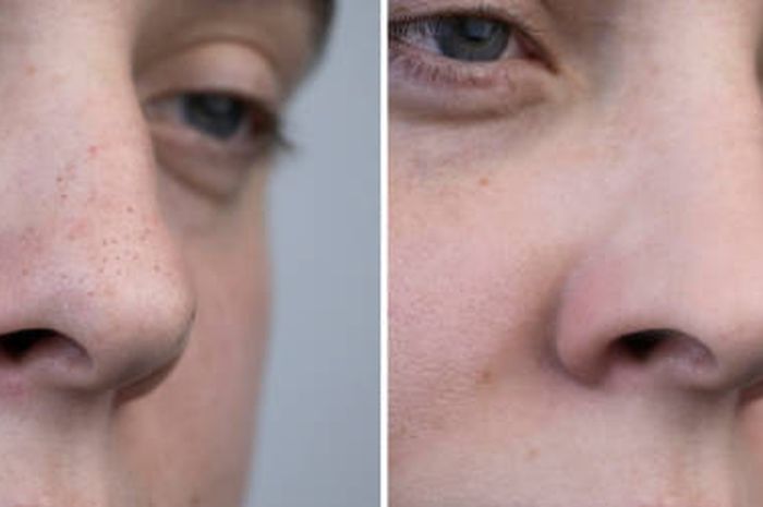 Tahan Dulu Beli Skincare! Komedo Bisa Lenyap Seketika Cuma dengan ...