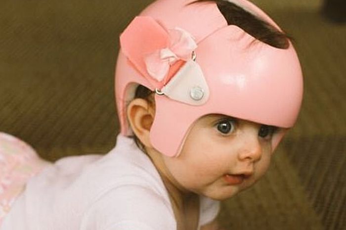 Terapi Helm Bisa Perbaiki Bentuk Kepala Bayi, Ini Cara Kerjanya - Nova