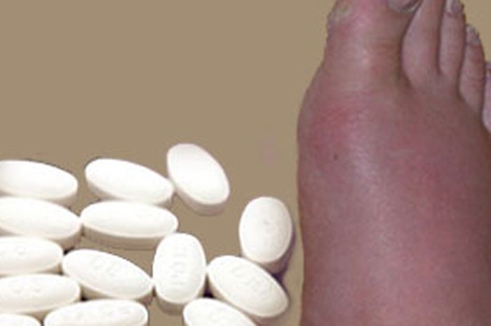 Daftar 12 Obat Asam Urat di Apotik Beserta Harga Terbaru, Harus Sesuai ...
